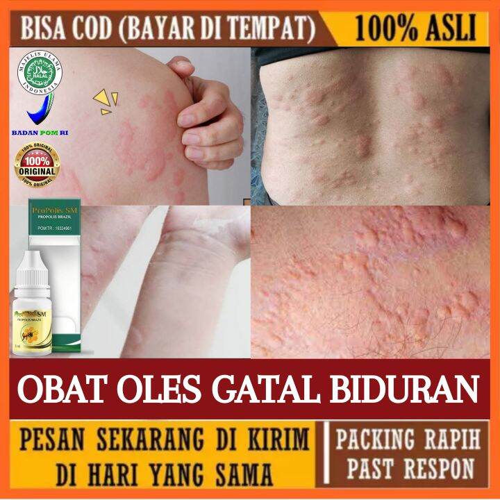 Obat Oles Gatal Biduran Herpes Kaligata Akut Kulit Melepuh Penghilang ...