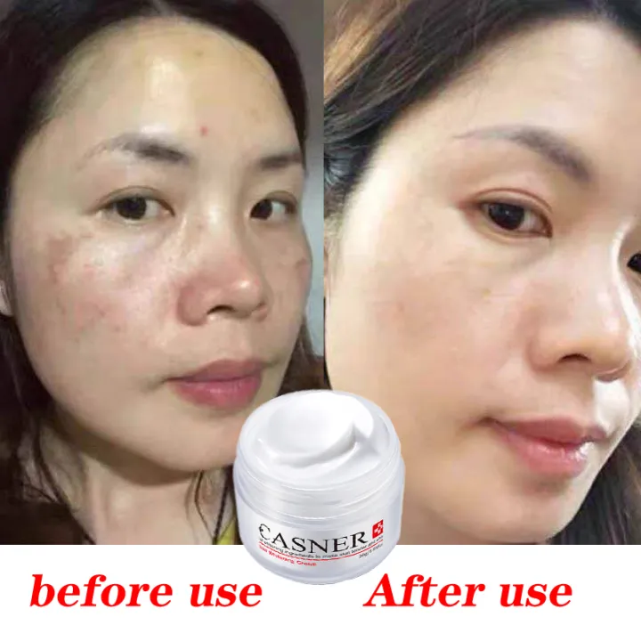 Whitening freckle removal cream original melasma cream Whitening ...