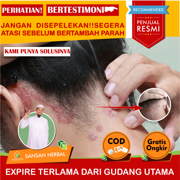 Obat Psoriasis Kepala, Ketombe Parah, Gatal Kulit Kepala, Kulit Kepala ... Obat Psoriasis Kepala, Ketombe Parah, Gatal Kulit Kepala, Kulit Kepala ...