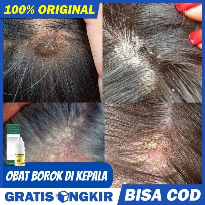 PROPOLIS Asli - Obat Borok Di Kepala - Kulit Kepala Bersisik - Ketombe Parah - Kulit Kepala ...