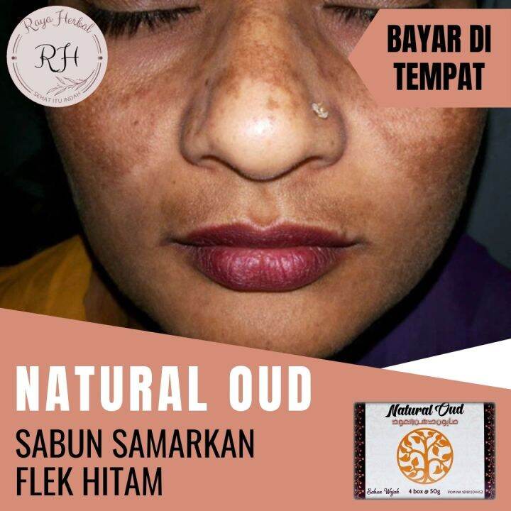 Sabun Wajah Untuk Flek Hitam NATURAL OUD 50gr - Sabun Cuci Muka Flek ...