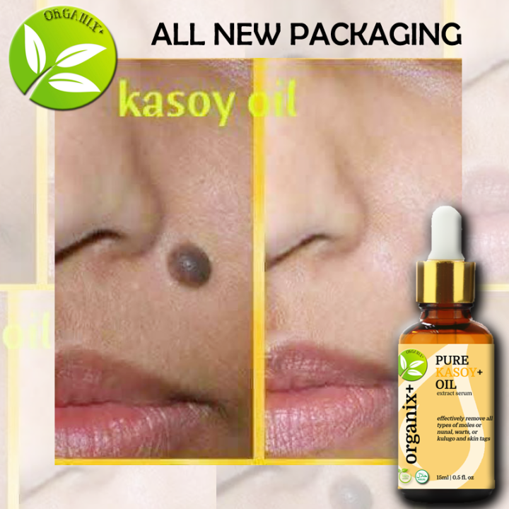 Pure Organic Authentic Kasoy Oil Warts Remover, Skin Tags Remover ...