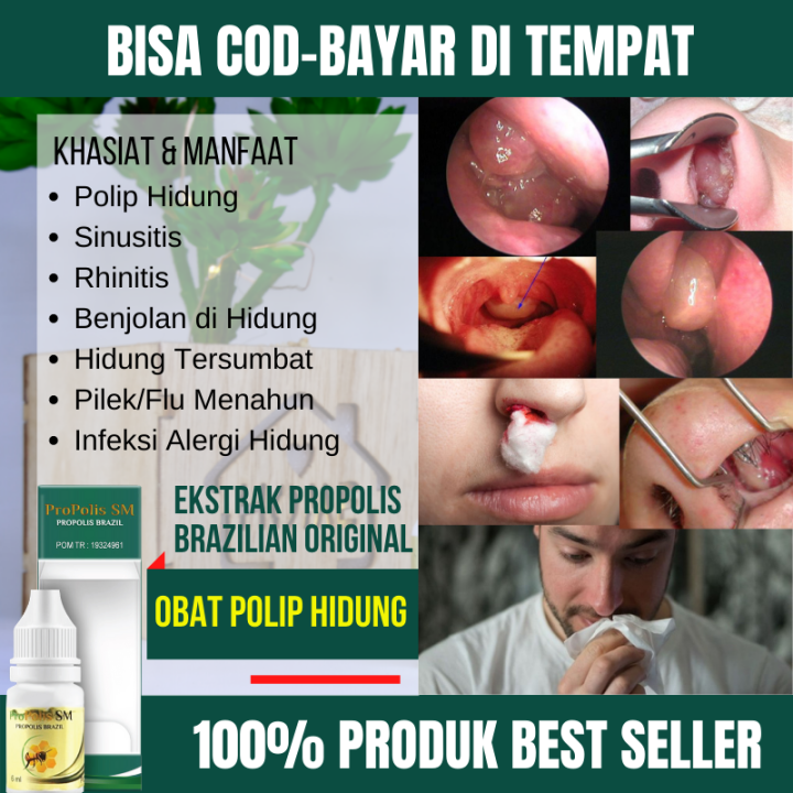 Obat Infeksi Alergi Pada Hidung, Obat Polip Hidung, Benjolan Akut, Rongga Hidung Tersumbat ...