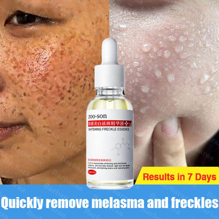 Melasma and pekas remover original japan melasma Essence original ...