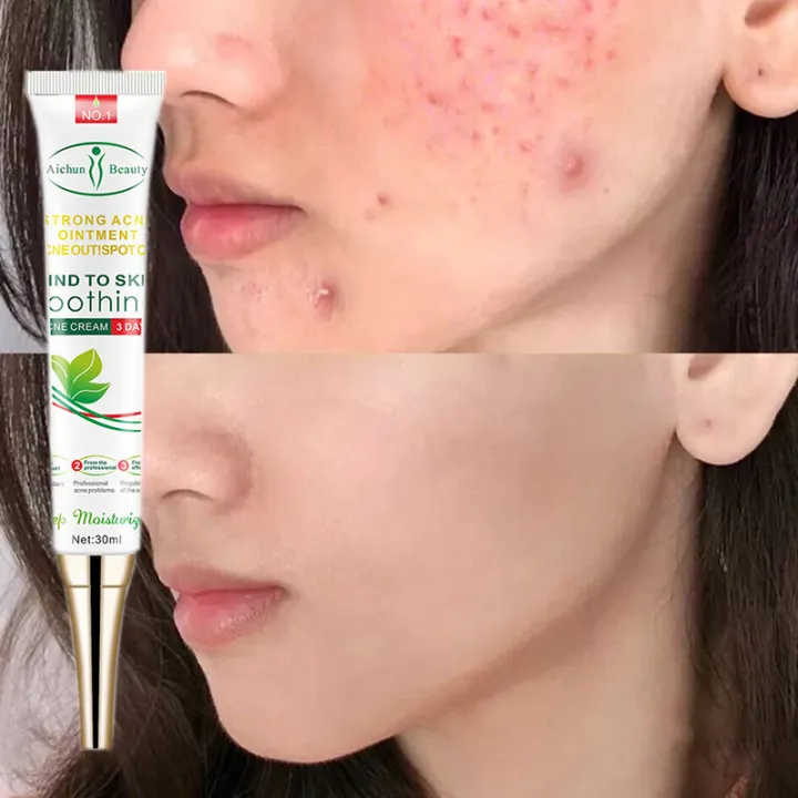 【COD】 ⚡ Acne Cream Pimple Eraser Pimple Marks Remover Treatment Acne ...