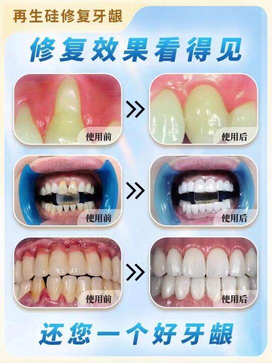 High efficiency Japan original Periodontitis and gingival recession ...