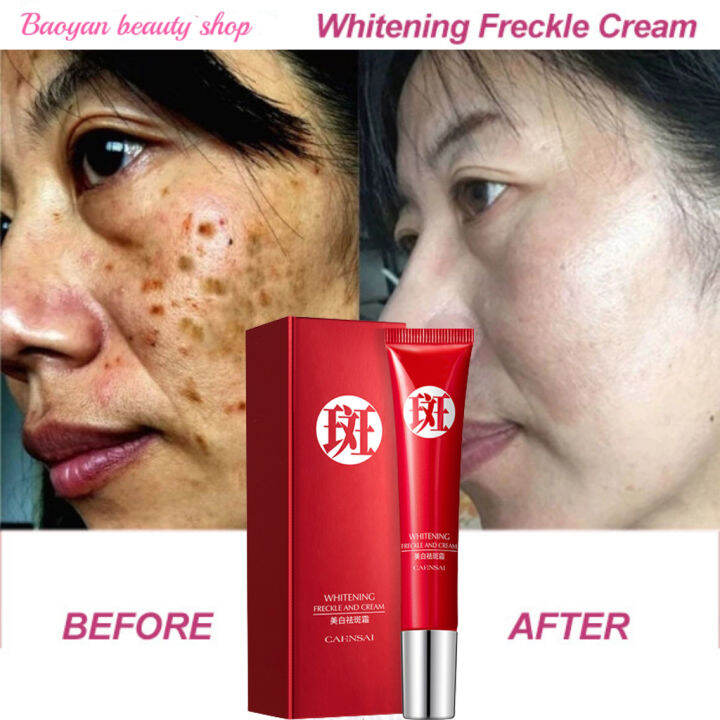 Original Strong Anti Freckle Whitening Cream Powerful Removing Age Dark Spots Pigmentation ...