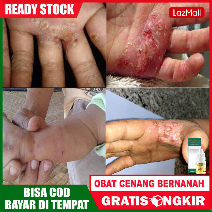 Obat Cenang Bernanah Di Telapak Tangan Kaki, Kulit Nanahan, Luka Borok ...