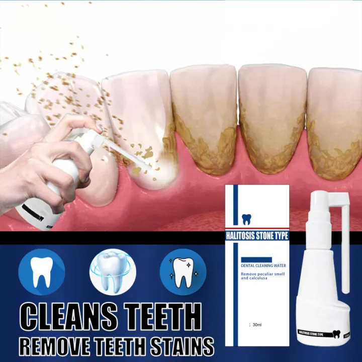 Dental Calculus Cleaning Halitosis Stone Type Remove Teeth Whitening ...