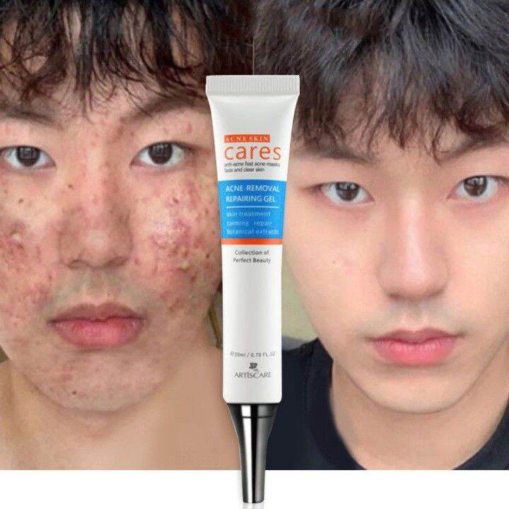 pimple remover cream acne marks remover cream skin care products anti ...