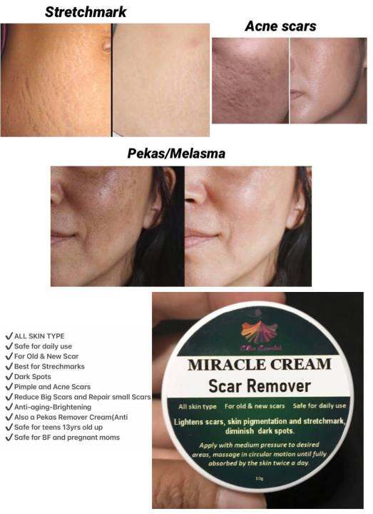 PEKLAT REMOVER MIRACLE CREAM BEST FOR MELASMA, PEKAS, STRETCHMARK 10G ...