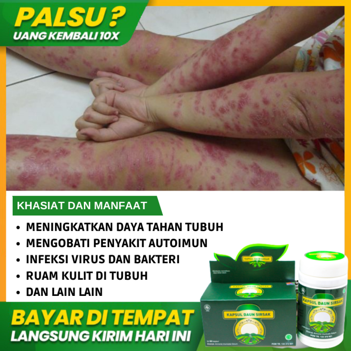 Obat Autoimun Paling Ampuh Penambah Daya Tahan Tubuh Penyakit Auto Imun ...