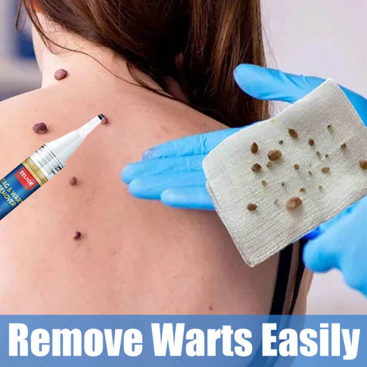Original Wart and Mole Remover Skin Tag Removal Pen Warts Remover Tool ...