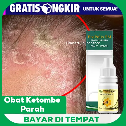 Obat ketombe parah - bersisik - berkerak - kulit kepala berketombe Asli 100% | Lazada Indonesia