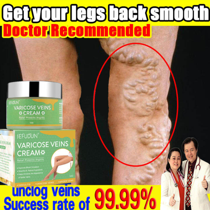 CNS 01-A Varicose Cream ORIGINAL | Varicose Veins Remove |Treatment ...