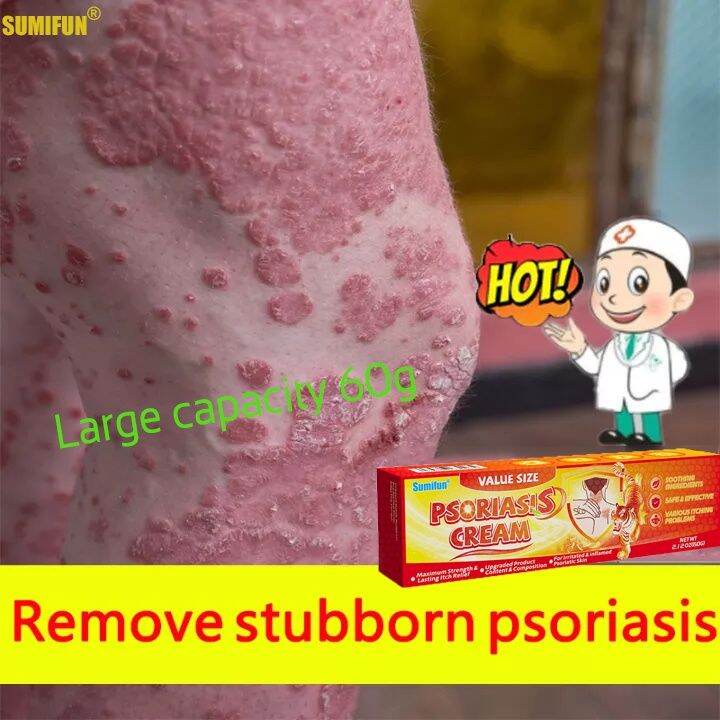 【Sumifun】 gamot sa kati kati sa balat Eczema Treatment Cream Ointment ...