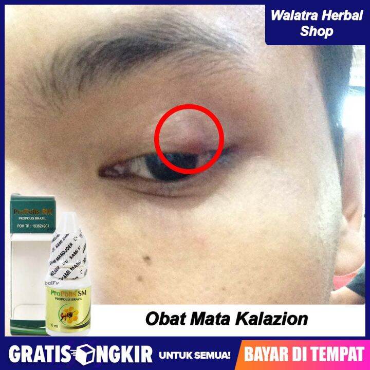 Obat Mata Kalazion - Benjolan di Kelopak Mata - Mata Bintitan - Mata ...
