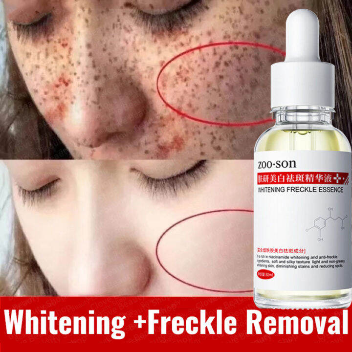 Niacinamide anti melasma serum melasma remover retinol cream original ...