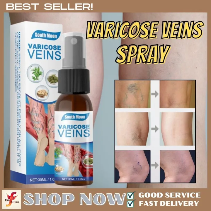 BEST SELLER!! Varicose Vein Spray 30ml Smoothes Bulging Blood Vessels ...