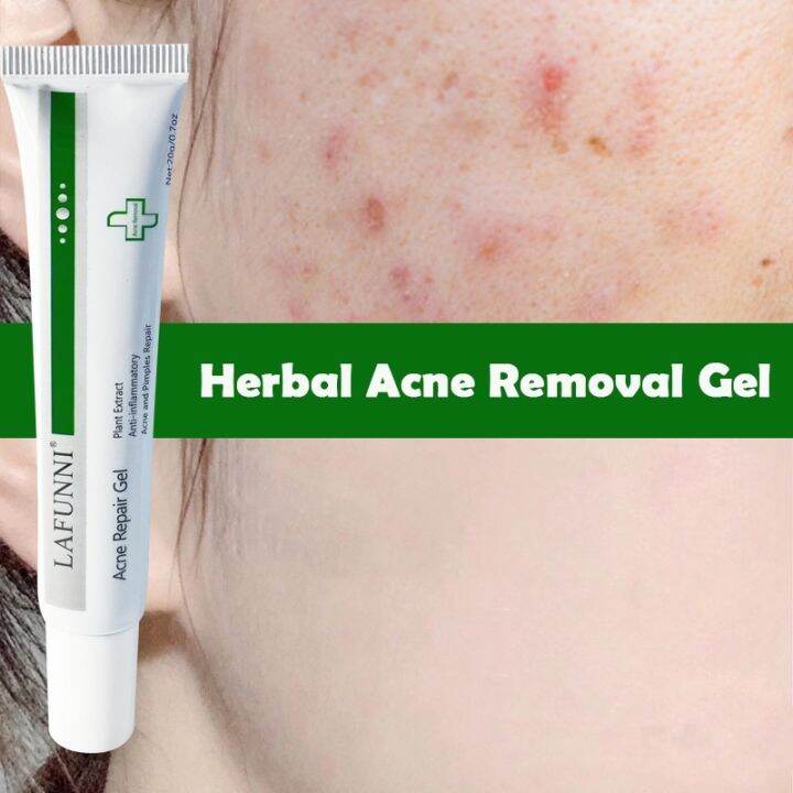 LAFUNNI Acne Treatment Gel Ointment Pimple Remover Redness Skin Care ...