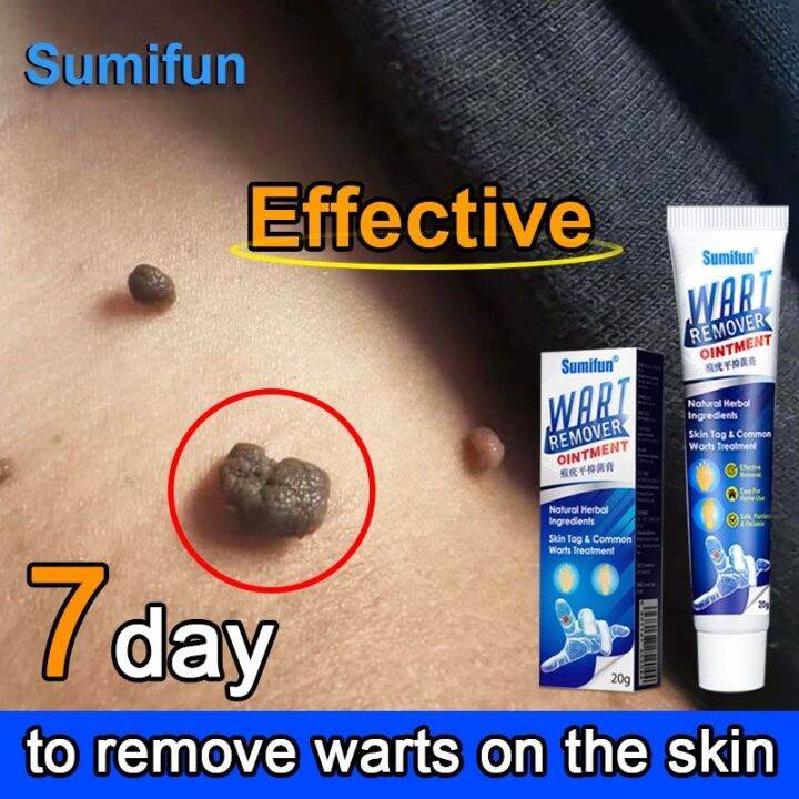 【SUMIFUN】Warts Remover Original Cream Warts Magic Remover Wartz Removal ...