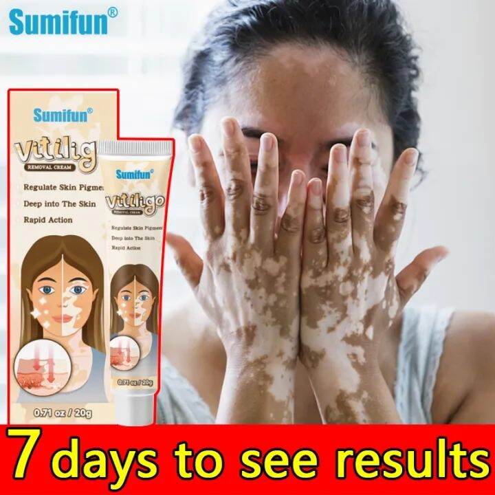 【stok siap 🙌】Vitiligo Cream Leukoplakia Disease Treatment Ointment ...