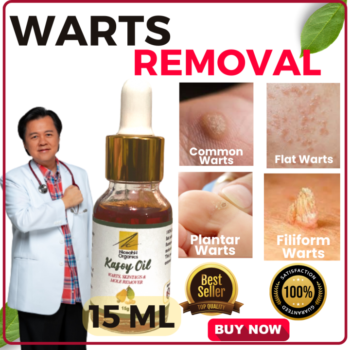 Niceahh Kasoy Oil and Kasoy Cream | Effective for Warts and Skin Tags ...