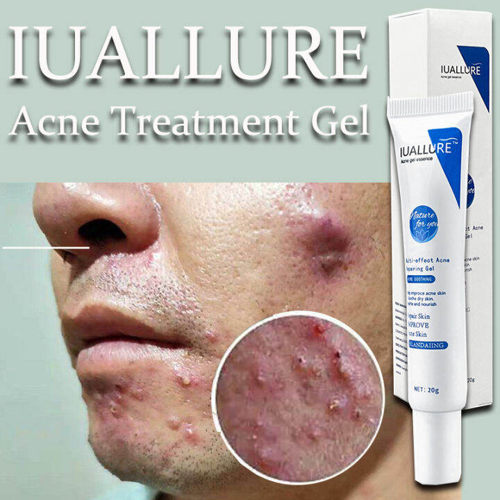 Original Strong Acne Pimple Gel Fades acne marks pustular cysts skin ...