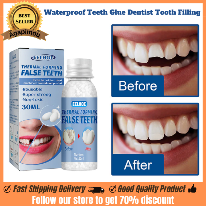 Waterproof Teeth Glue Dentist Tooth Filling Hole Filler Fix Kit ...