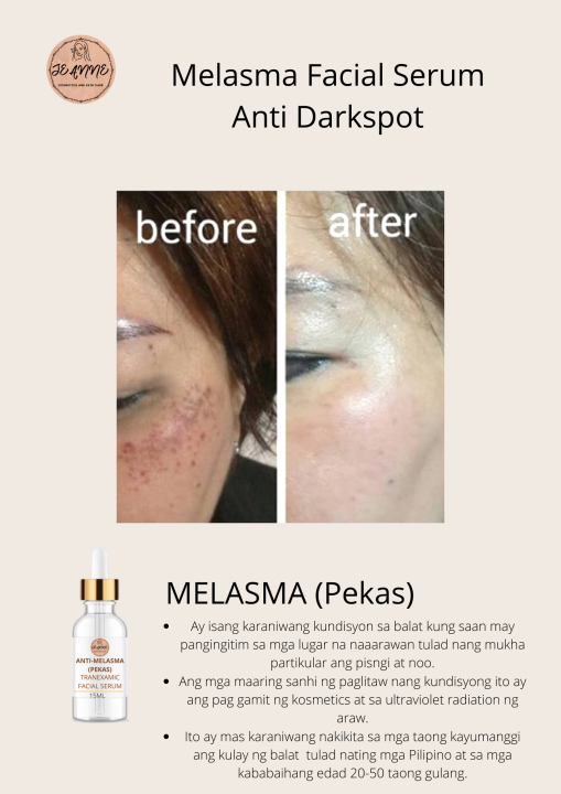 Effective freckle removal whitening serum melasma removal original pekas remover serum anti ...