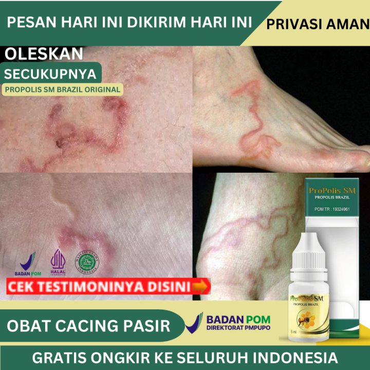Obat Cacing Pasir, Obat Cutaneous Larva Migrans, Penghilang Cacing ...