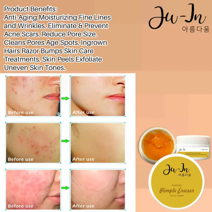 Original Ju-In Korean Pimple Eraser Facial Cream Whitening Moisturizing ...