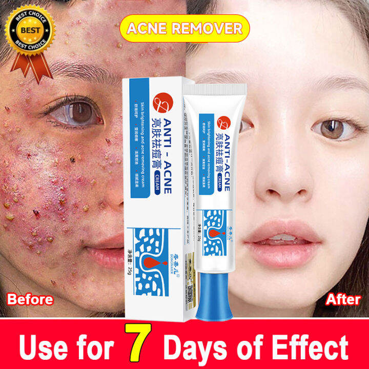 Remove Pimples Quickly Remover Acne Cream Fades Acne Marks Repairs Acne Pits Facial Scar Care ...