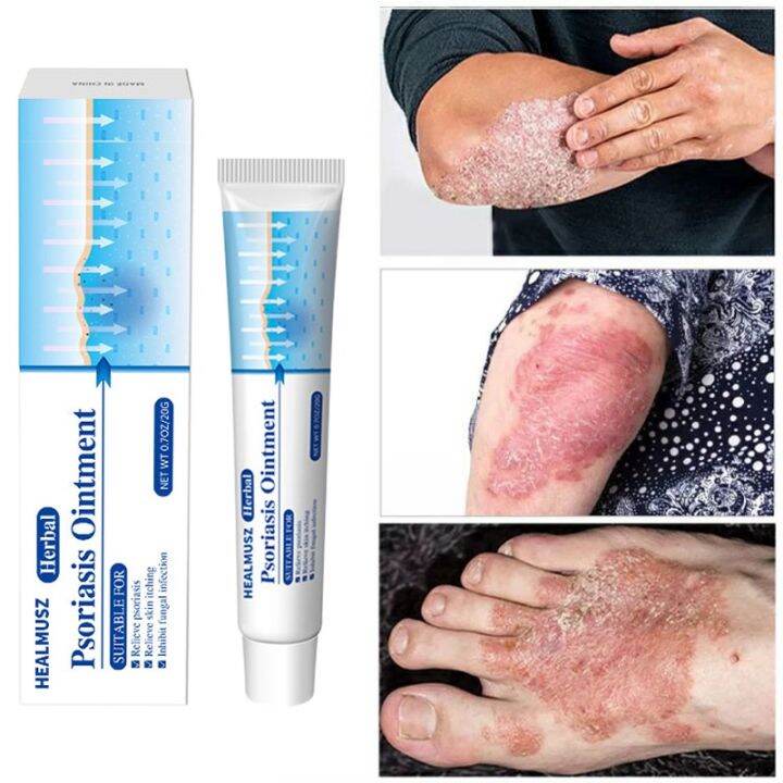Antibacterial Psoriasis Cream Anti Itch Eczema Cream Relief Skin Rash ...