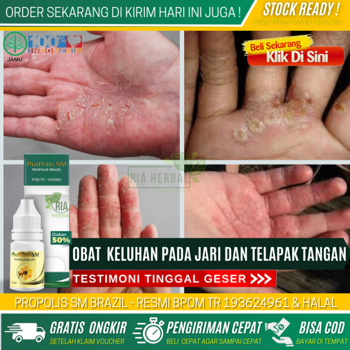 Obat Penghilang Gatal Kulit Karena Alergi Semen, Obat Alami Dermatitis ...