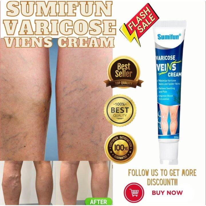 Varicose Veins Cream Phlebitis Vasculitis Treatment Cream Thigh Spider ...