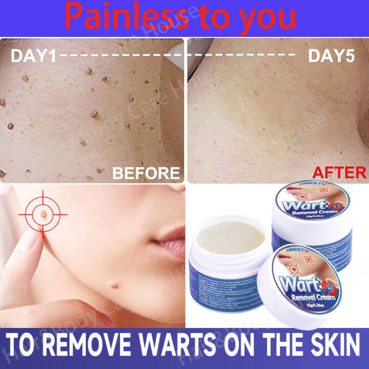 【Painless to you】Wart Removal Cream Fast Remove Skin Tag Remover ...
