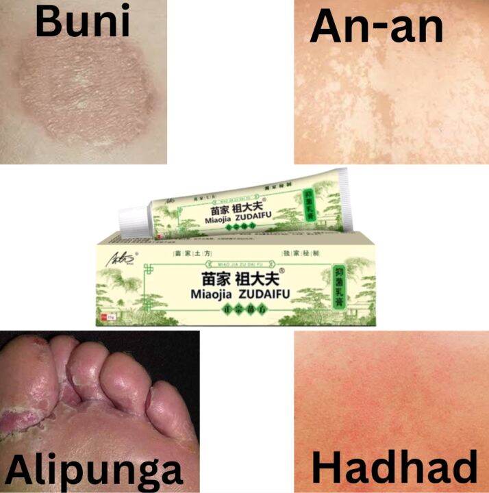 Gamot sa An-an, Hadhad, Buni, Alipunga, Psoriasis Ezcema at iba pang ...