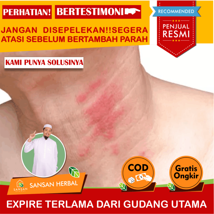 Obat dermatitis, untuk dermatitis, kulit dermatitis, gatal dermatitis ...