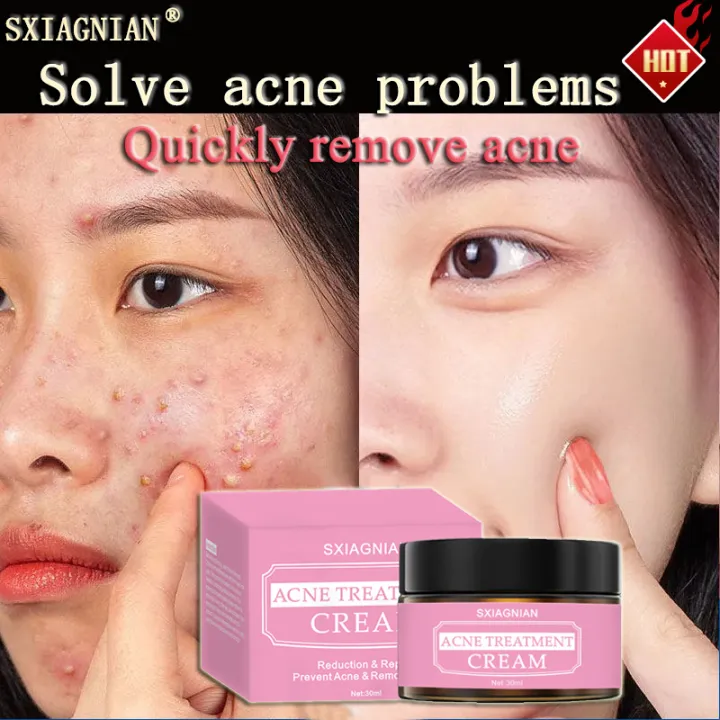 SXIAGNIAN Acne cream ,Acne pimples removal cream Quickly remove acne ...