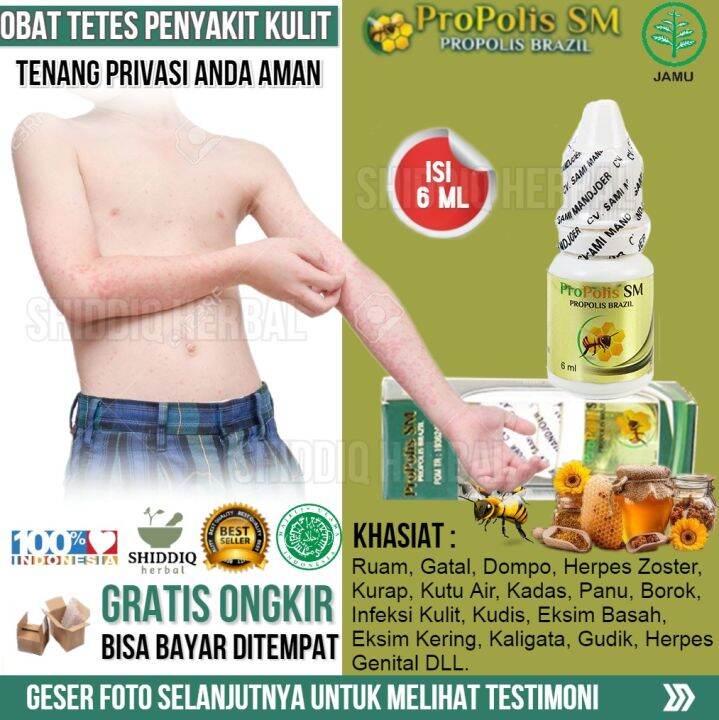 Salep Oles Dermatitis Atopik, Obat Tetes Bisul, Obat Tradisional Gatal ...