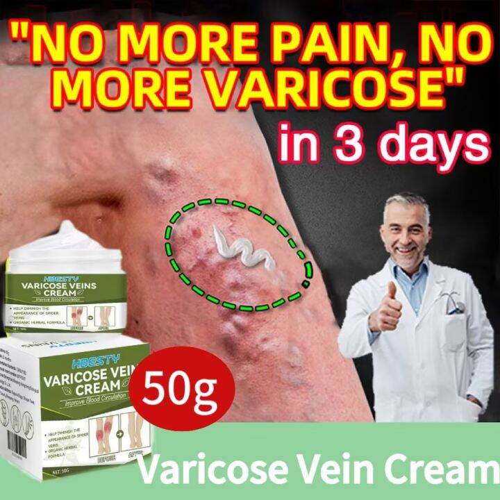 Varicose Vein Cream 50g Treat Vasculitis Phlebitis Spider Leg Pain ...