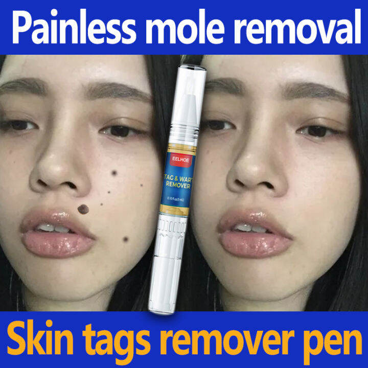 【Hot Sale】Skin mole removal pen Mole remover Wart removal Painless mole ...
