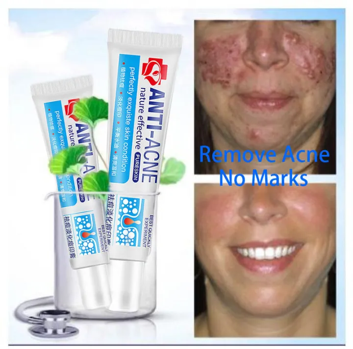 Eliminate Acne Whitening Cream gentle remove pimple cream acne ...