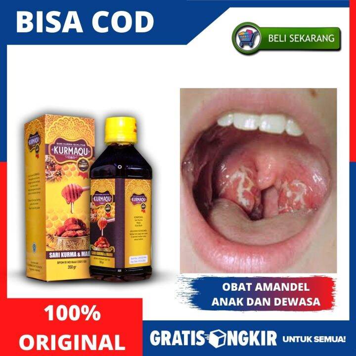 Obat Amandel Anak (Aman Tanpa Efek Samping) - Herbal Buat Amandel ...