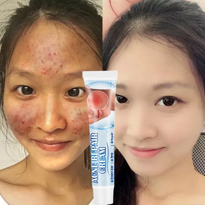 Remove Pimples Quickly Pimple Remover Acne Cream Fades Acne Marks Repairs Acne Pits Facial Scar ...