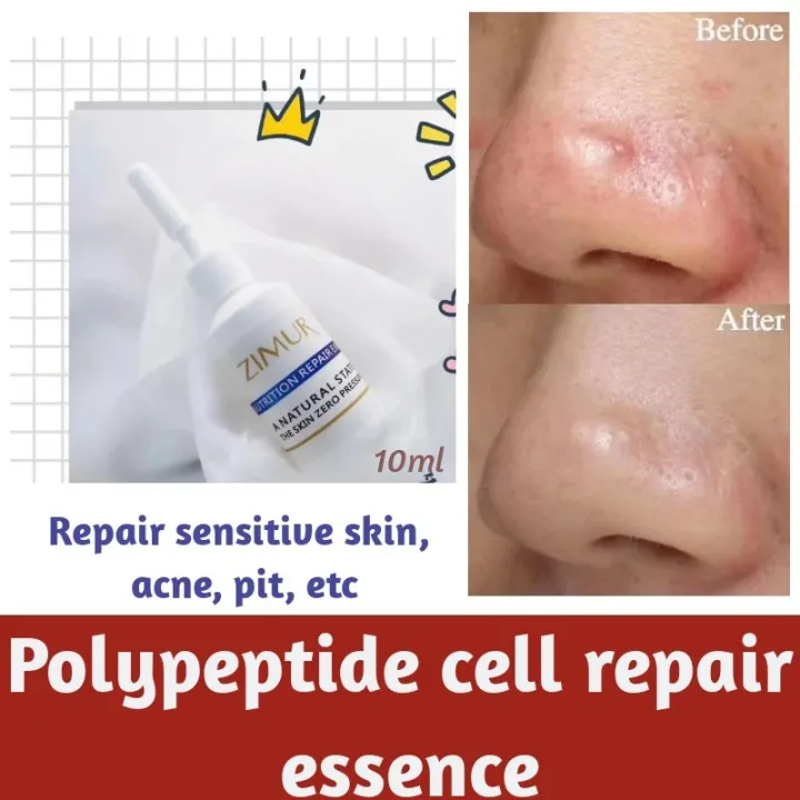 Polypeptide Cell Growth Factor Acne Skin Sensitive Skin Facial ...