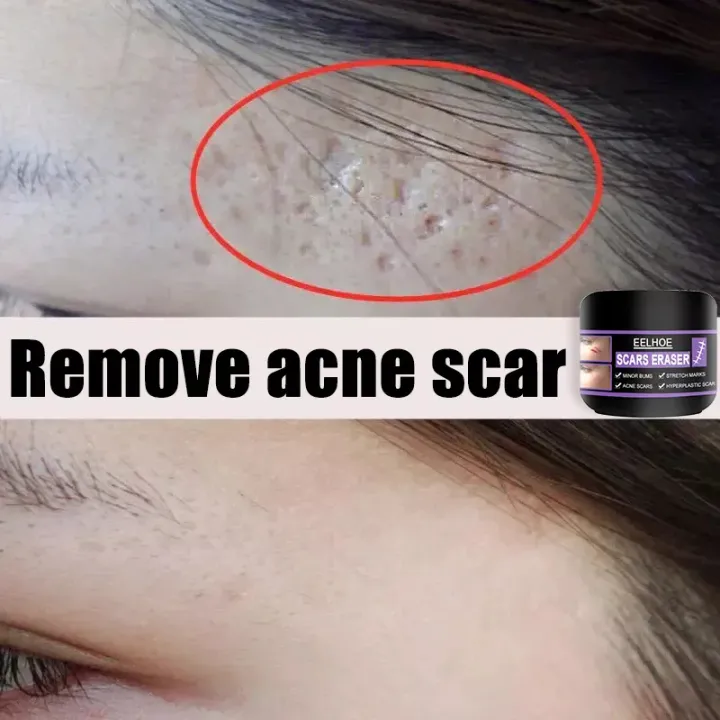 【COD】Buy 2 Get 1 👍🏻 Scar Remover Scar Remover For Old Scar On Legs ...