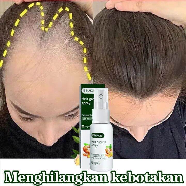 Eelhoe Hair Growth Spray Penumbuh Rambut Clothes Of Skin 7 Days Ginger