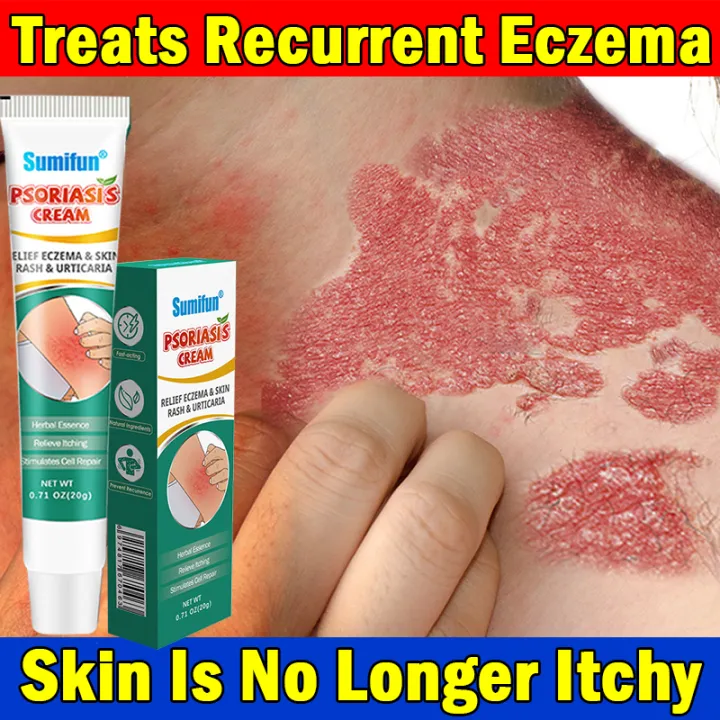 Sumifun Herba Psoriasis Eczema Treatment Ointment Cream 20g Professional Treatment Of Skin